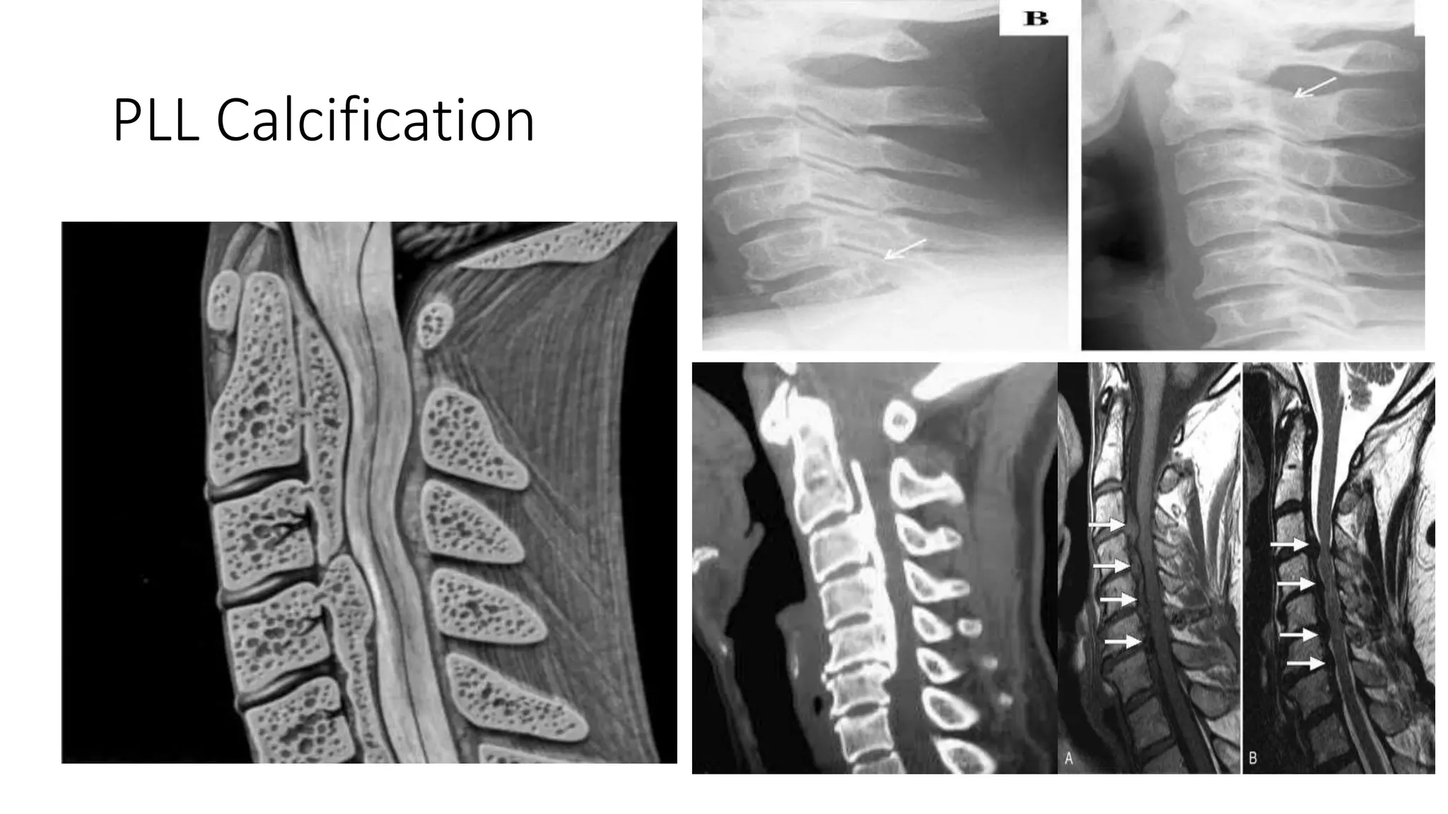 Degenerative Spine Disease.pptx