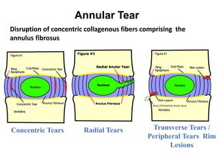 Degenerative Spine Diseases.ppt