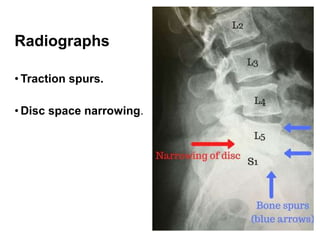 Degenerative Spine Diseases.ppt