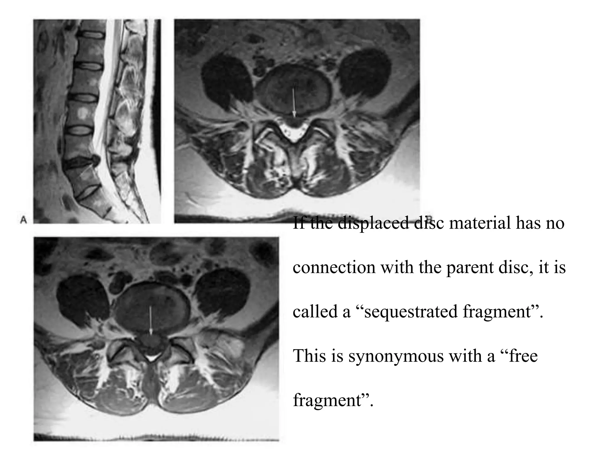 Imaging in degenerative diseases of spine | PPTX