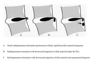 Imaging in degenerative diseases of spine | PPTX