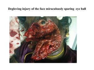 Degloving injury of face miraculously sparing eye ball | PPTX