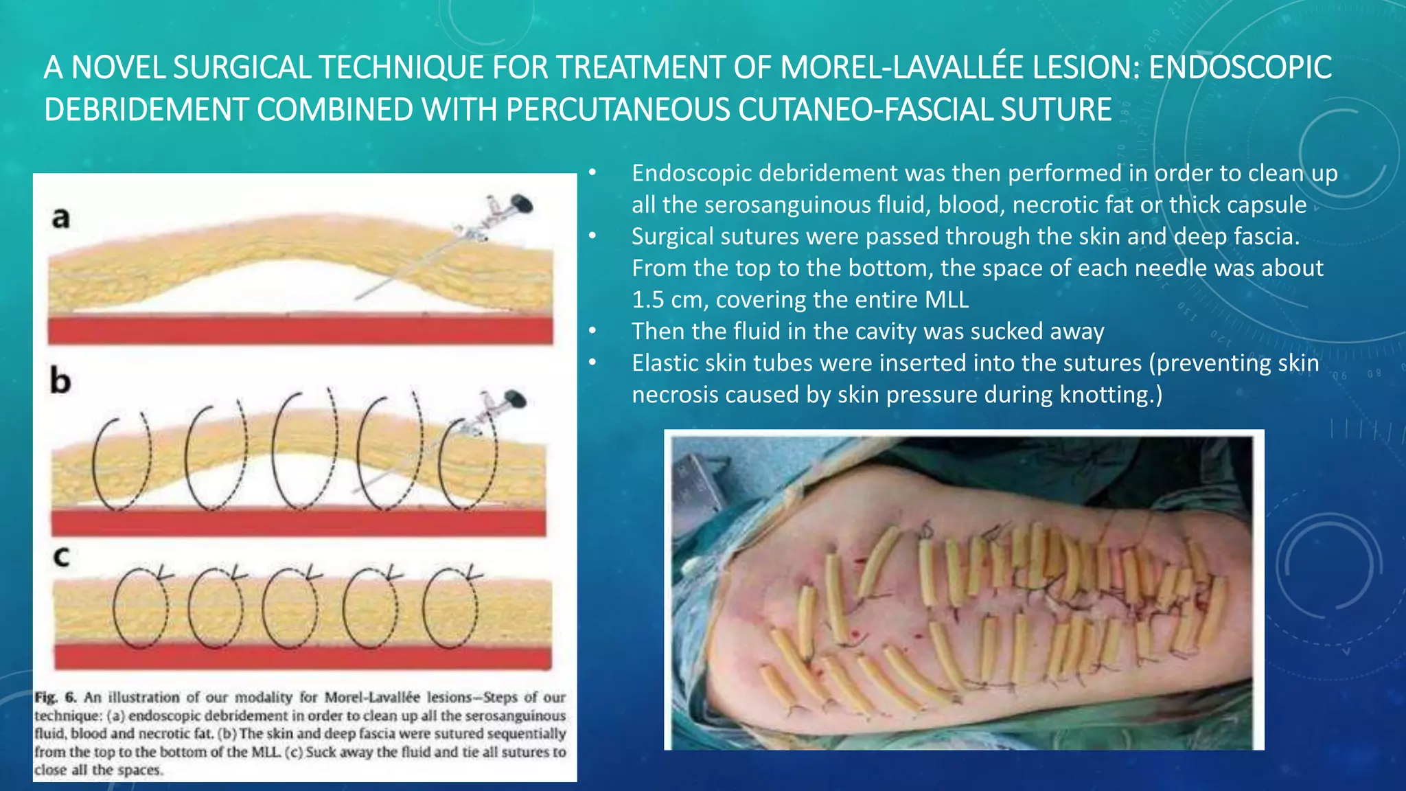 degloving injury - Andi.pptx