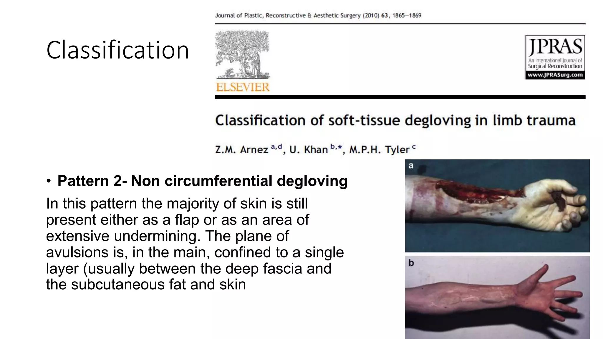 Degloving wound.pptx