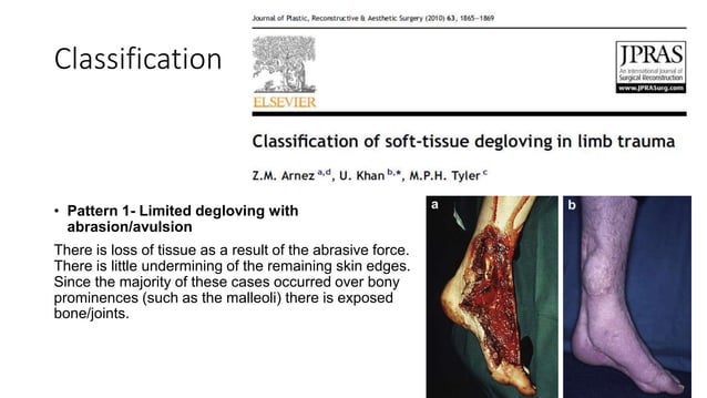 Degloving wound.pptx