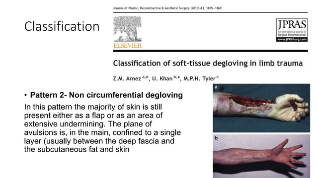 Degloving wound.pptx