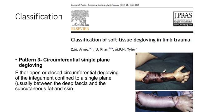 Degloving wound.pptx