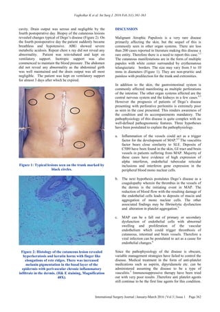 Bowel perforation in Dego’s disease: a lethal surgical scenario Ketan | PDF