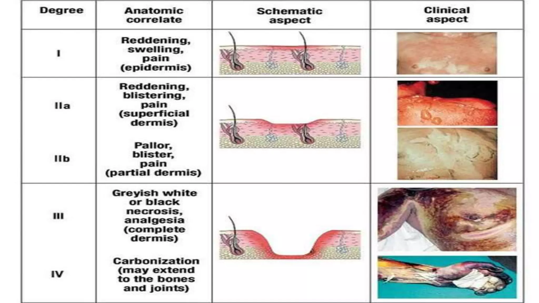 Degrees of burns | PPTX