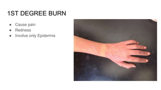 Degrees of burns | PPTX