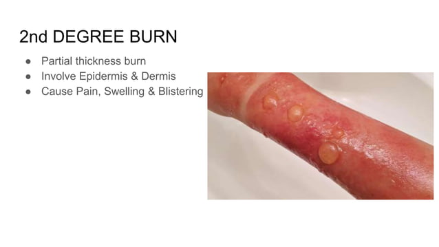 Degrees of burns | PPTX