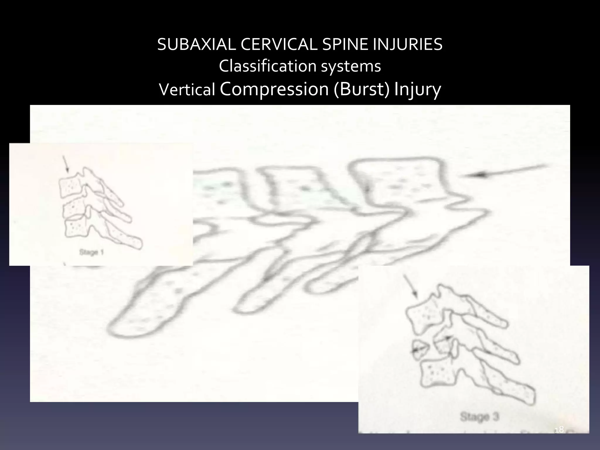 Subaxial Cervical Spine Injuries | PPTX