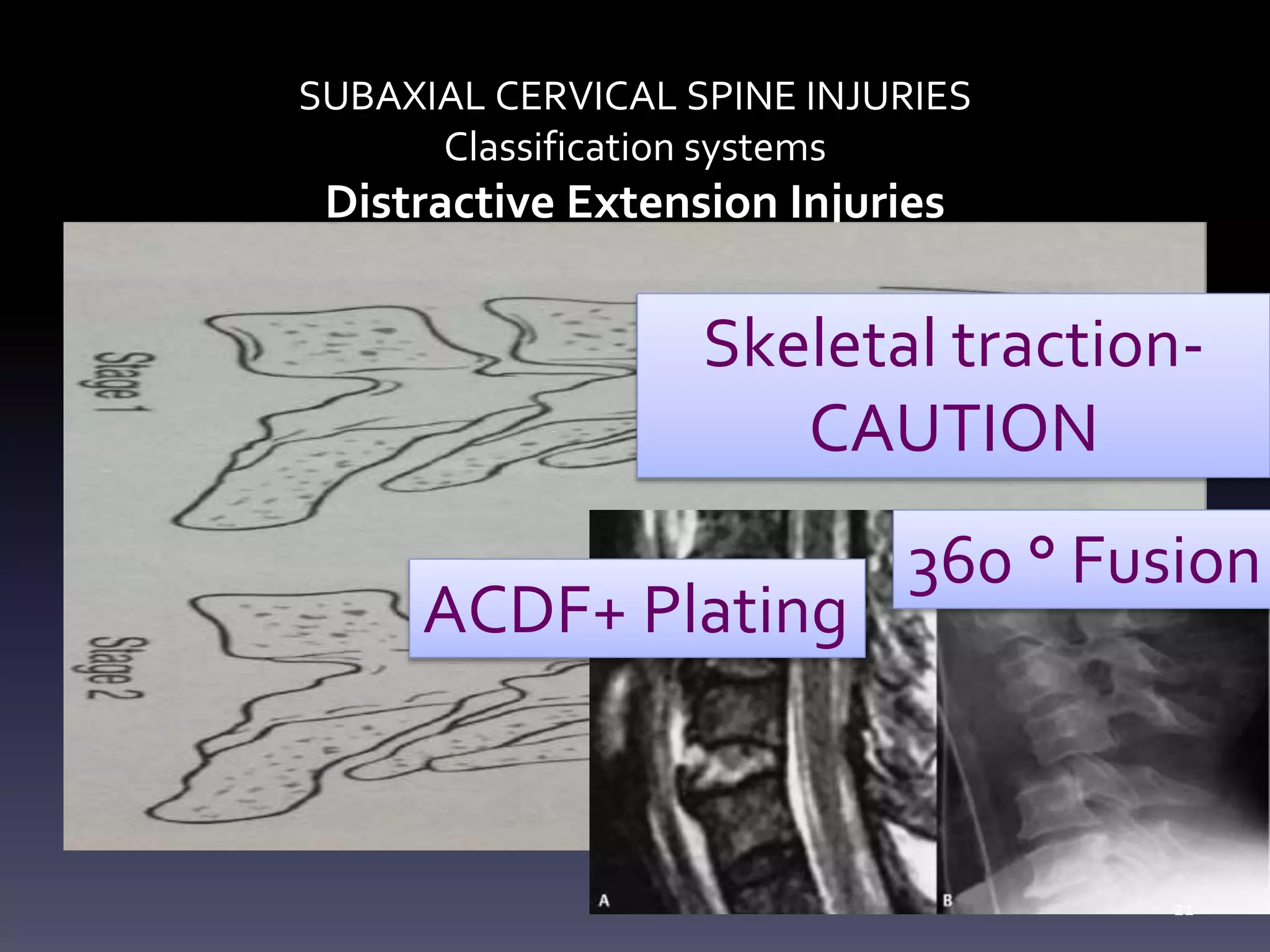 Subaxial Cervical Spine Injuries | PPTX