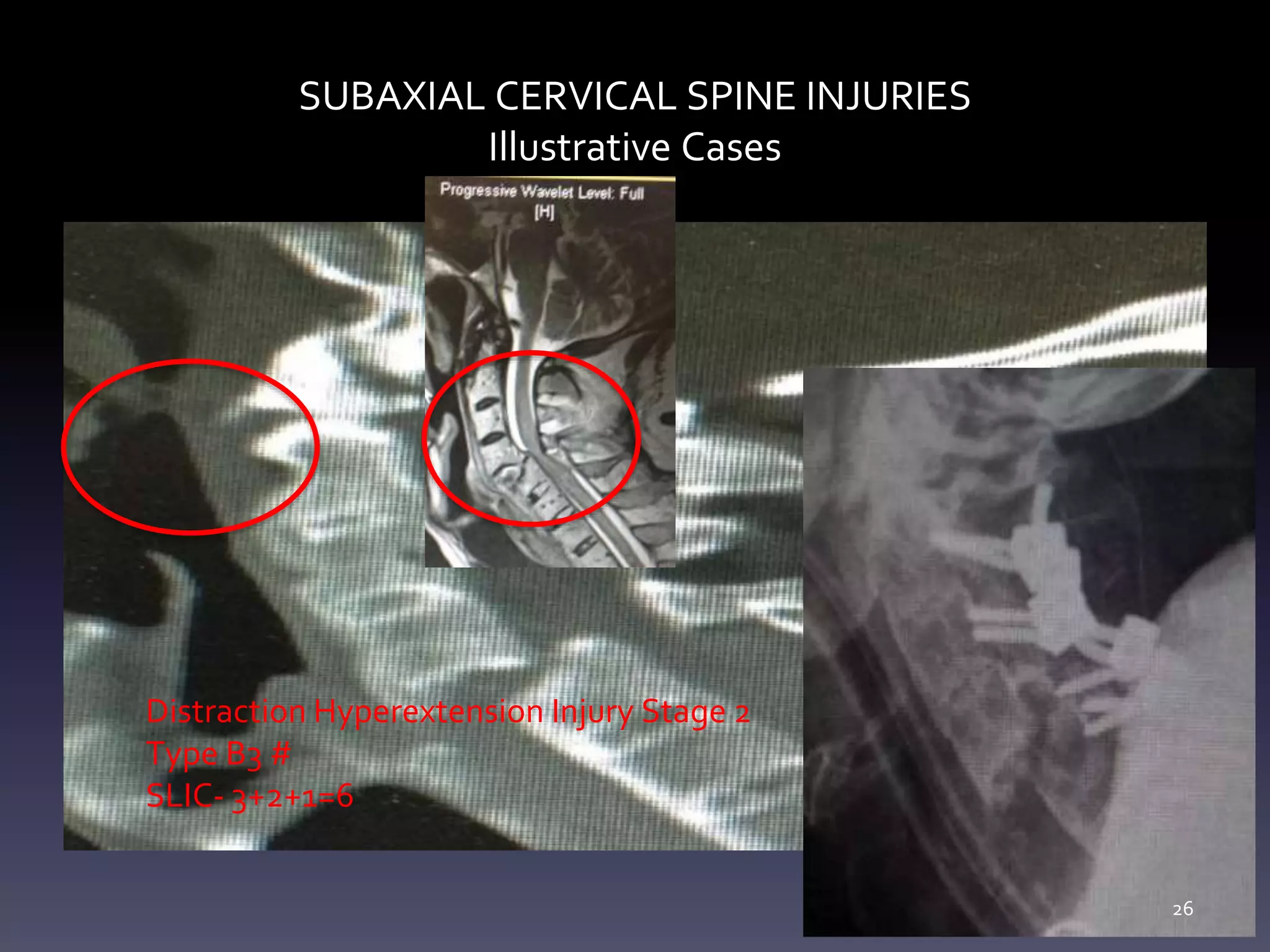 Subaxial Cervical Spine Injuries | PPTX
