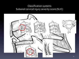 Subaxial Cervical Spine Injuries | PPTX