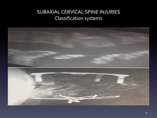 Subaxial Cervical Spine Injuries | PPTX