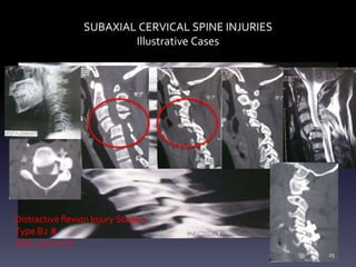 Subaxial Cervical Spine Injuries | PPTX