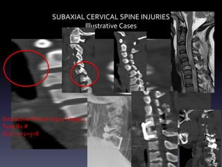 Subaxial Cervical Spine Injuries | PPTX