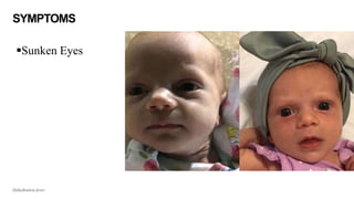 Dehydration fever in newborn | PPT | Free Download