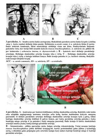Dešinysis aortos lankas su veidrodiniu brachiocefalinių arterijų ...