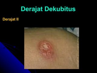 Perawatan Dekubitus | PPS