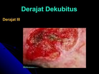 Perawatan Dekubitus | PPS
