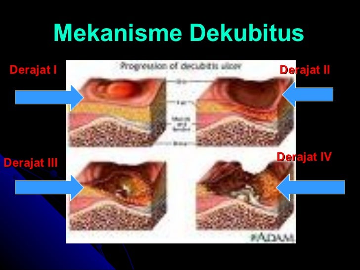 Kenali Proses Penyembuhan Luka Penderita Ulkus Dekubi