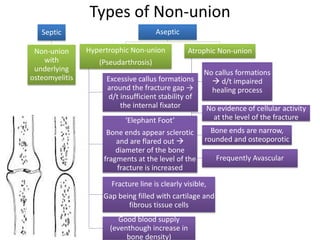 Delayed fracture healing | PPTX