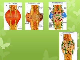 Delayed union and non union | PPTX