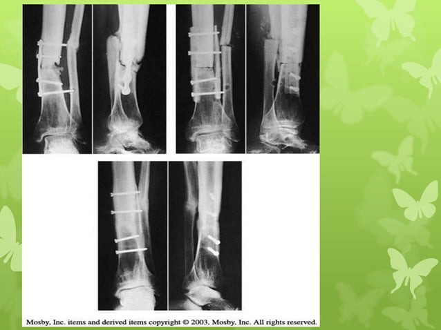 Delayed union and non union | PPTX
