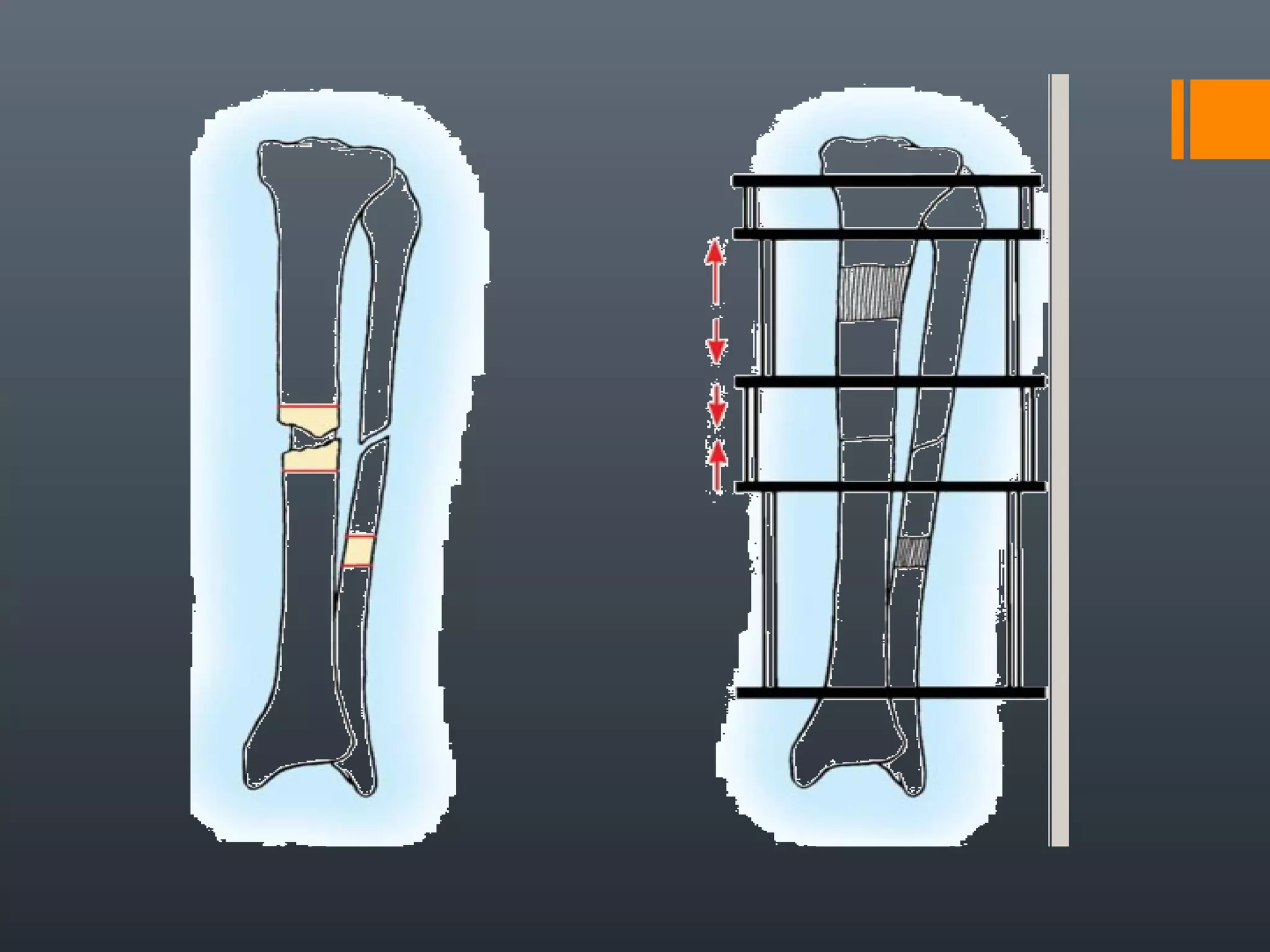 Delayed Union & Nonunion of Fractures | PPT