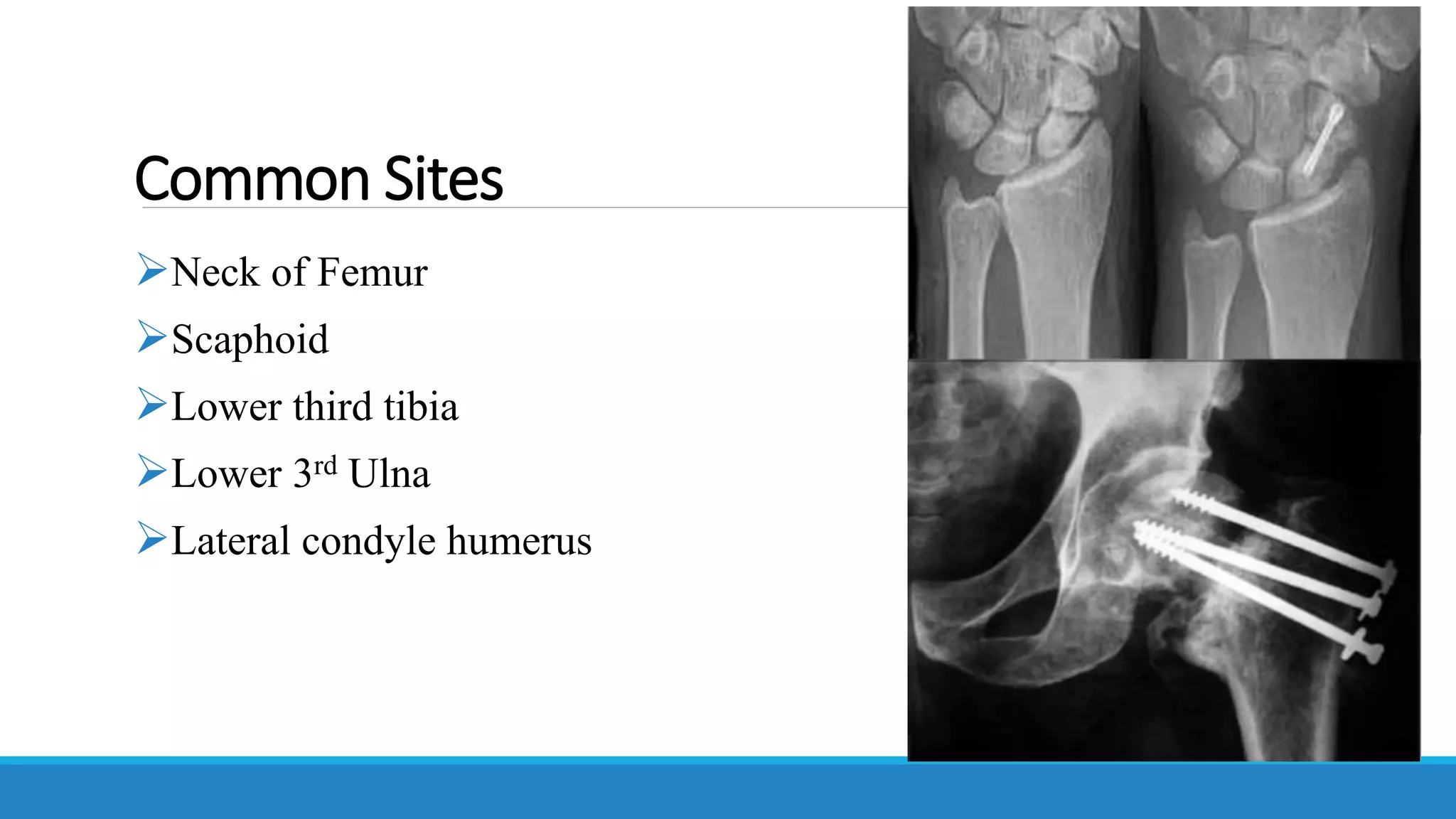 Delayed Unions and Nonunion | PPTX