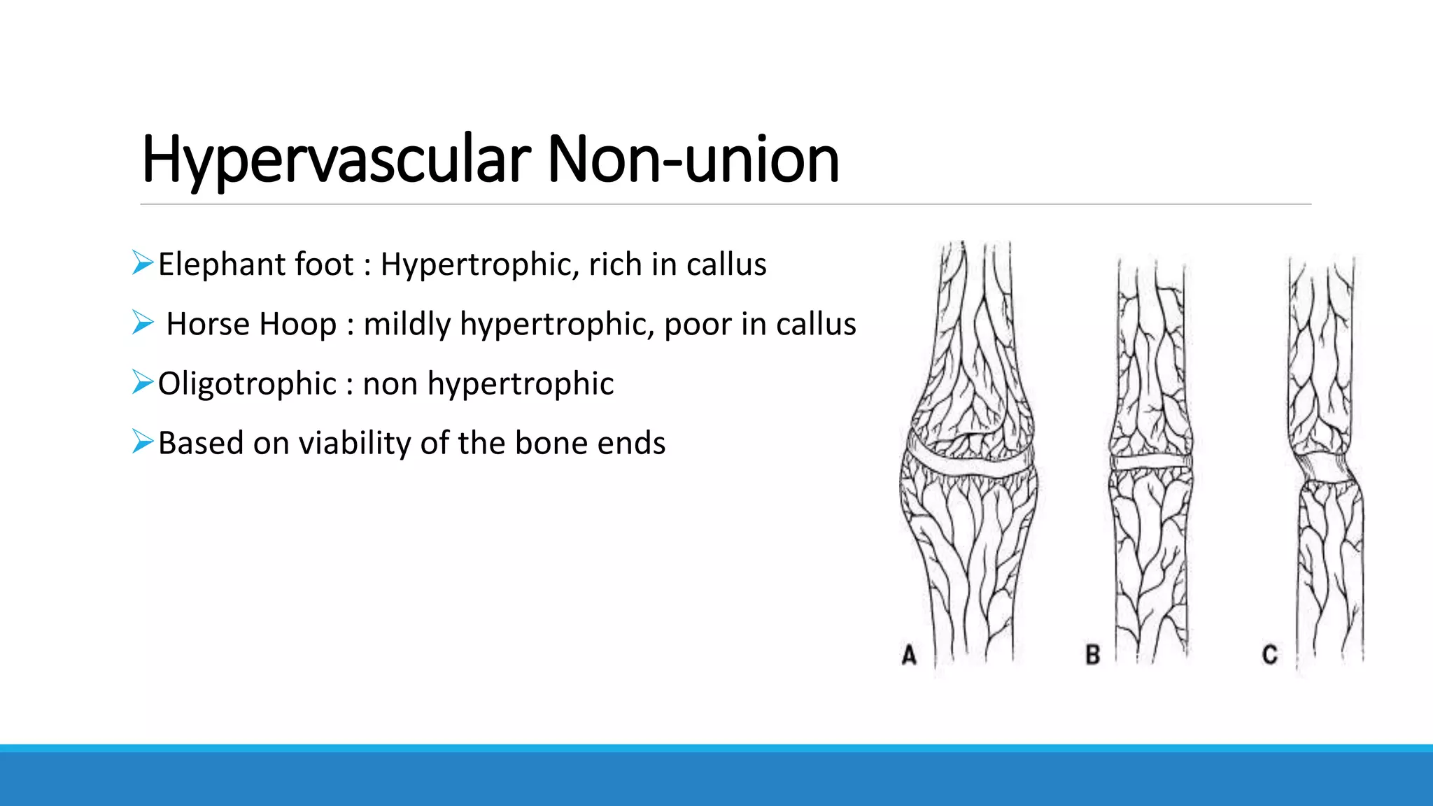 Delayed Unions and Nonunion | PPTX