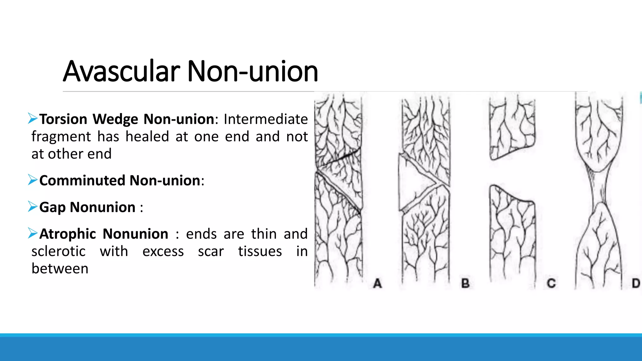 Delayed Unions and Nonunion | PPTX