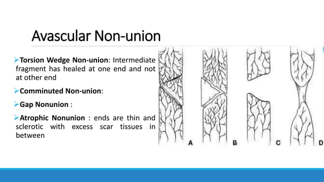 Delayed Unions and Nonunion | PPTX | Bone and Joint Conditions ...