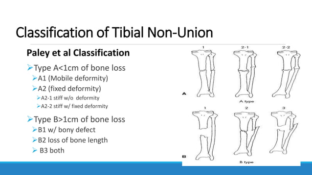 Delayed Unions and Nonunion | PPTX | Bone and Joint Conditions ...