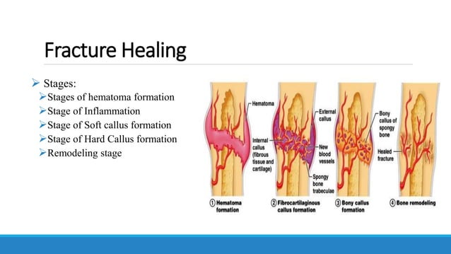 Delayed Unions and Nonunion | PPTX | Bone and Joint Conditions ...
