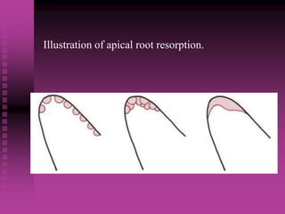 Deleterious effects of orthodontic force (4th BDS) | PPTX