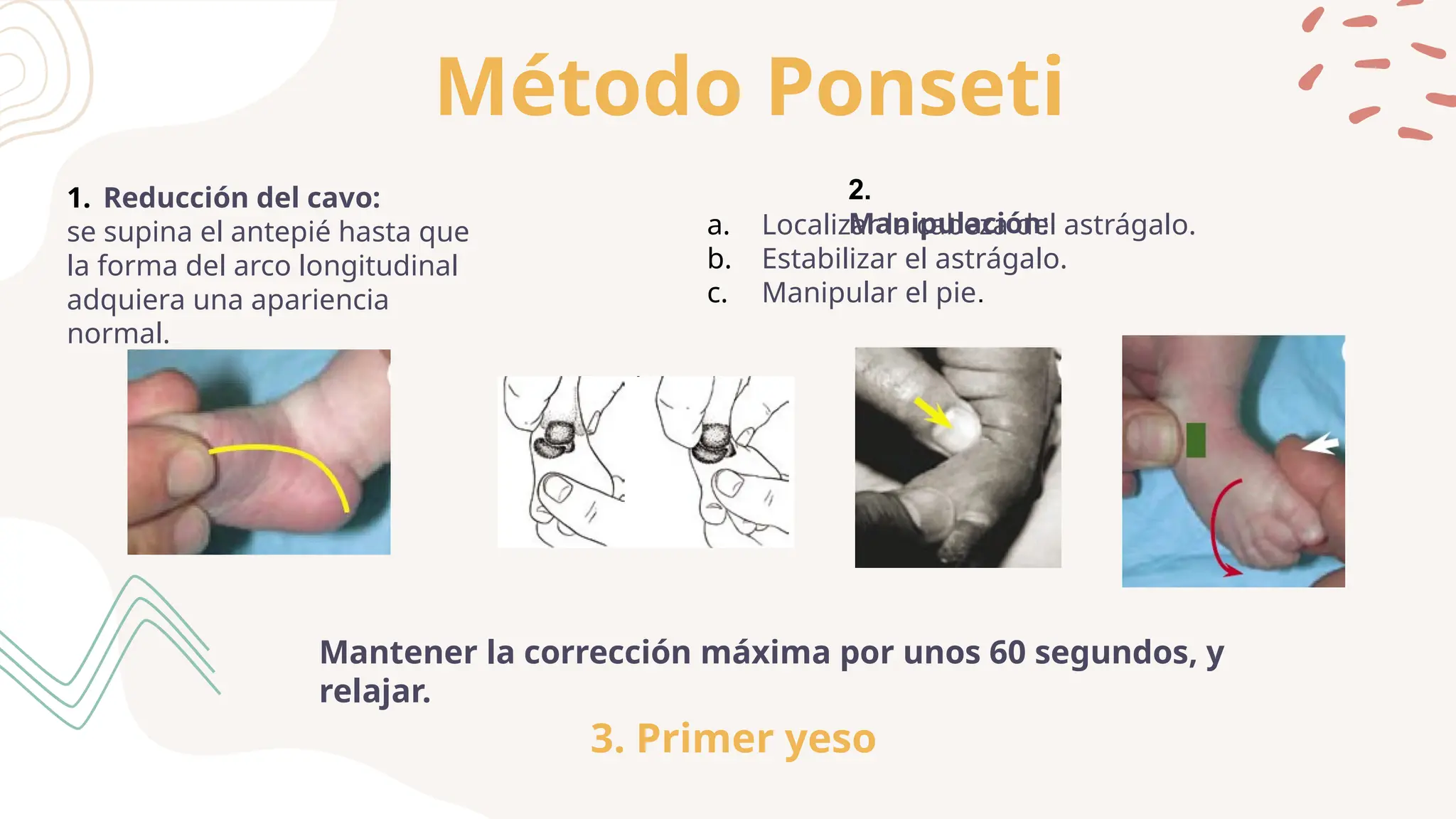 Pie bot y abordaje con el metodo ponseti | PPTX