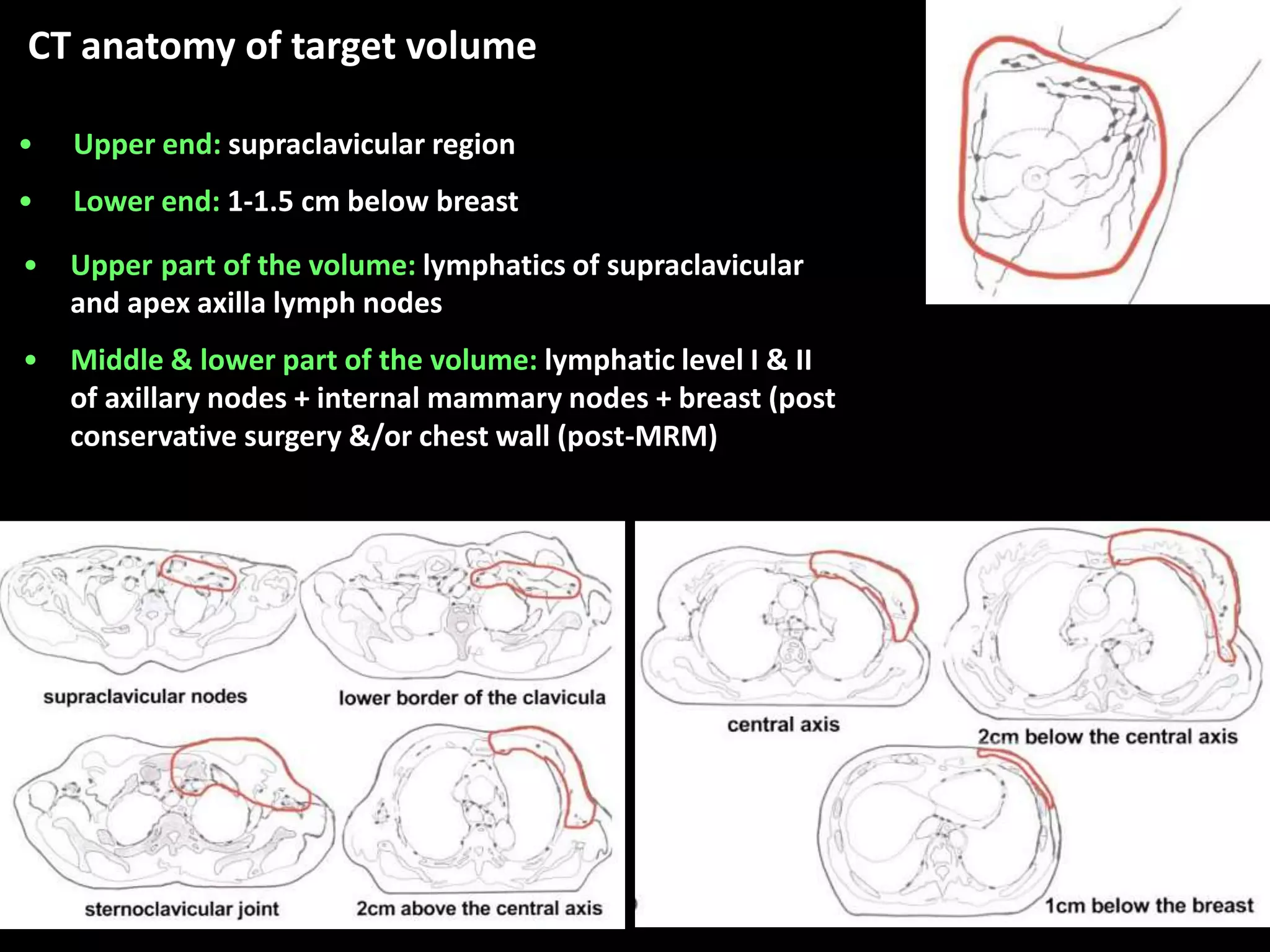 Delineation of breast cancer part ii | PPTX