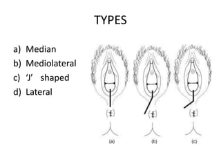 DELIVERY EPISIOTOMY.pptx
