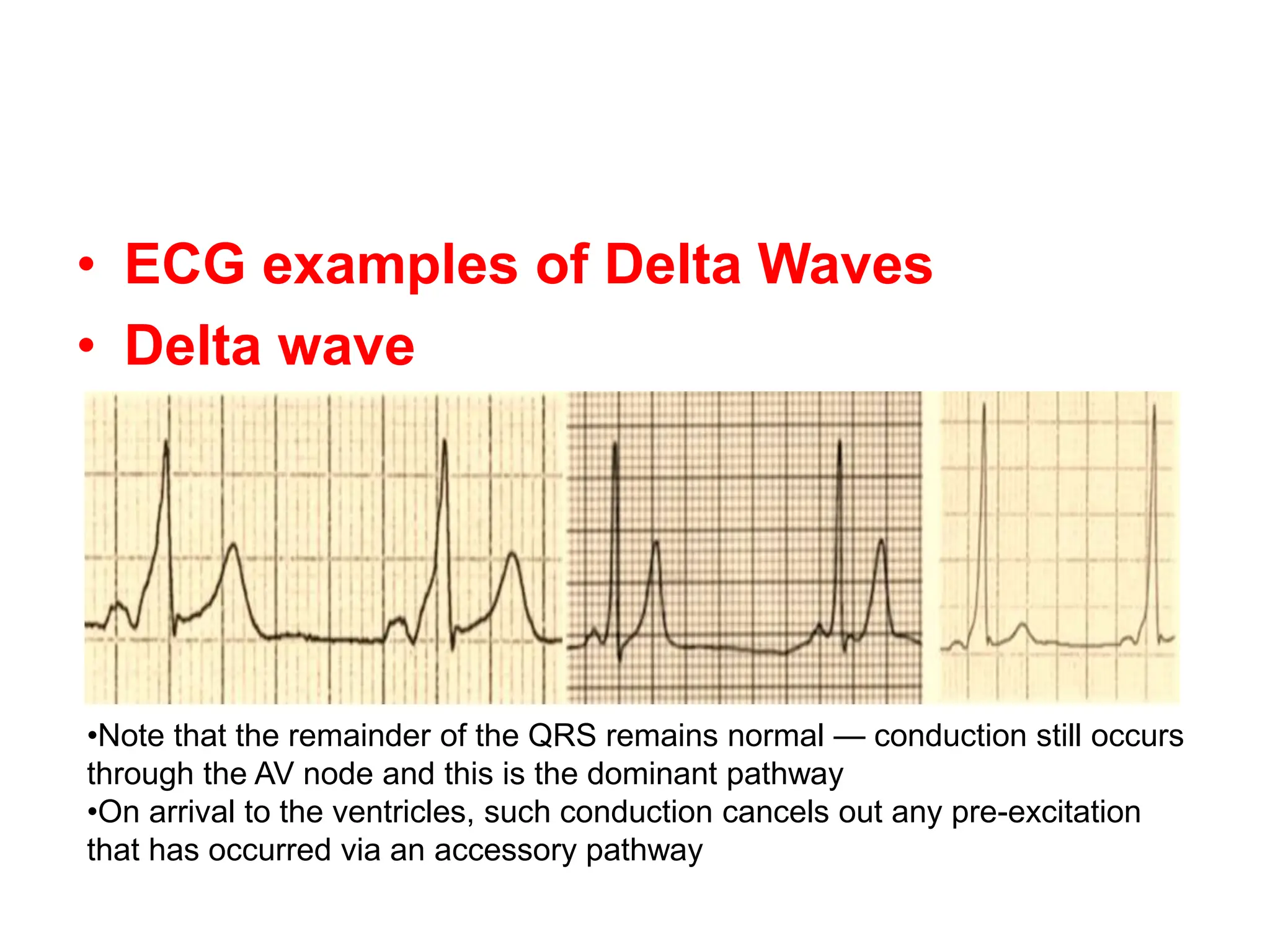 DDELTA WAVE IN ECG AND ITS INTERPRETATION IN ECG | PPTX
