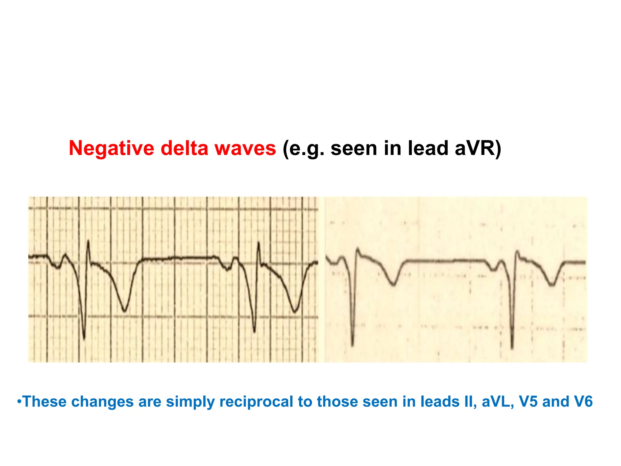 DDELTA WAVE IN ECG AND ITS INTERPRETATION IN ECG | PPTX