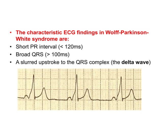 DDELTA WAVE IN ECG AND ITS INTERPRETATION IN ECG | PPTX | Heart and ...