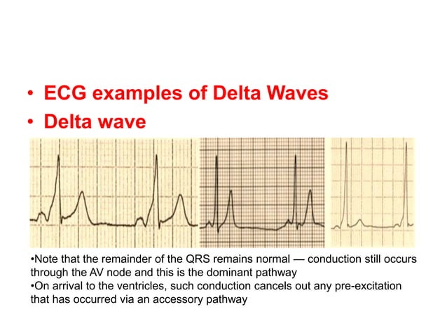 DDELTA WAVE IN ECG AND ITS INTERPRETATION IN ECG | PPTX | Heart and Cardiovascular Diseases ...