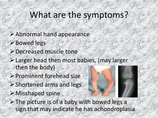 Achondroplasia | PPTX