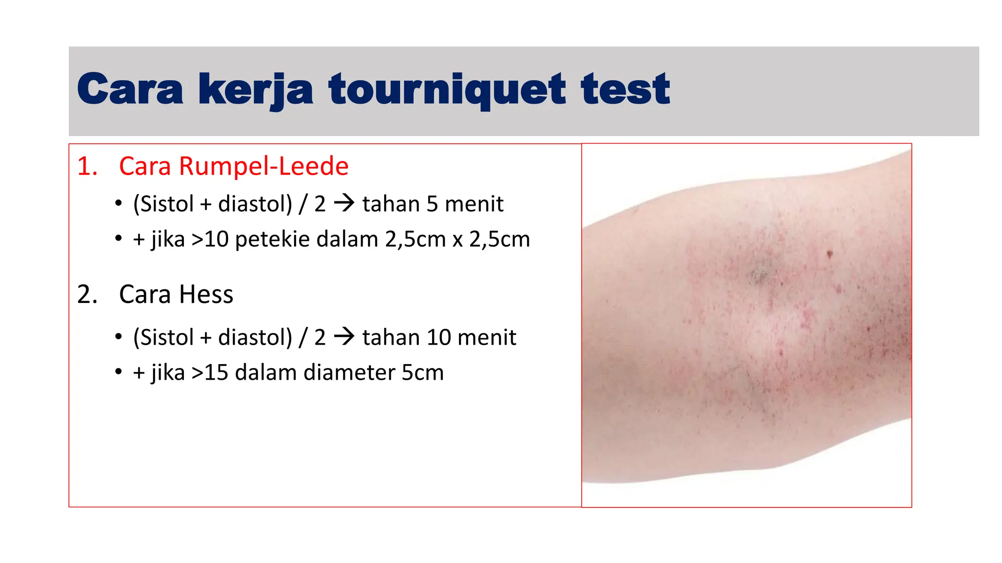 DEMAM BERDARAH DENGUE-YARSI-2024.pptx... | PPTX