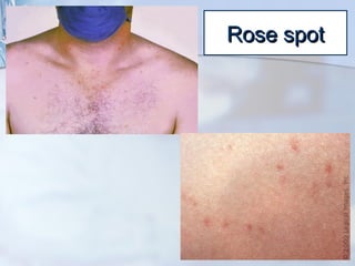 Demam tifoid puskesmas cynthia | PPT