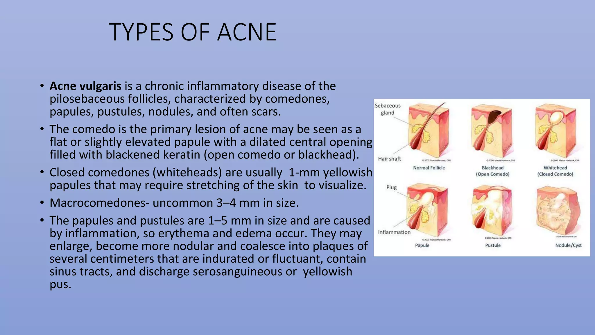 Acne dermatology 1.pptx