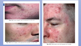Acne dermatology 1.pptx